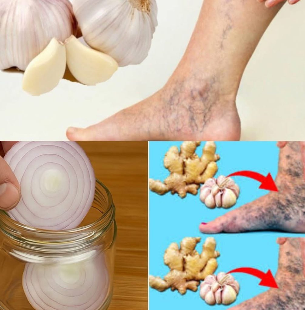 Natural Garlic-Onion-Ginger Vein Relief Ointment – Anas Food